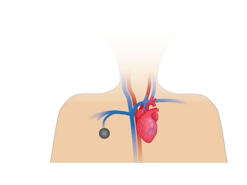 Portkatheter I Ein Leitfaden für Betroffene und Angehörige
